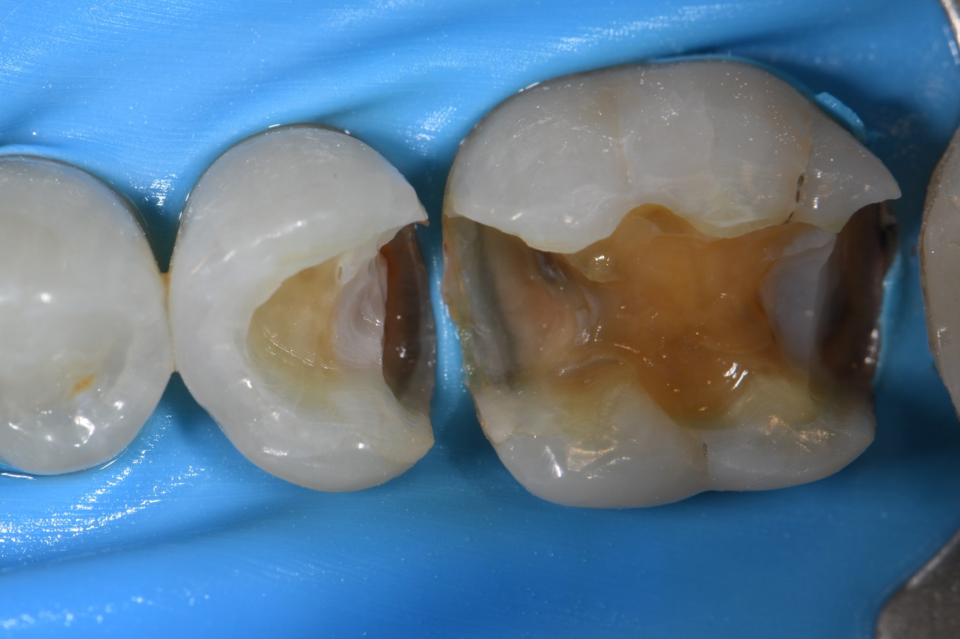 Rebuilding Posterior Teeth