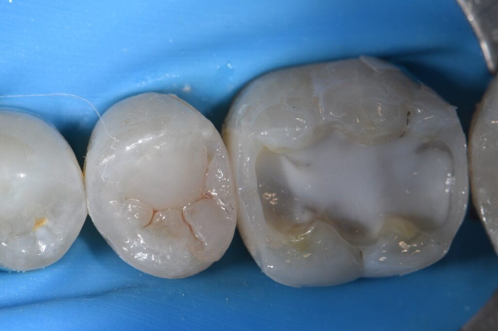 Rebuilding Posterior Teeth