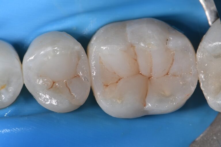 Rebuilding Posterior Teeth