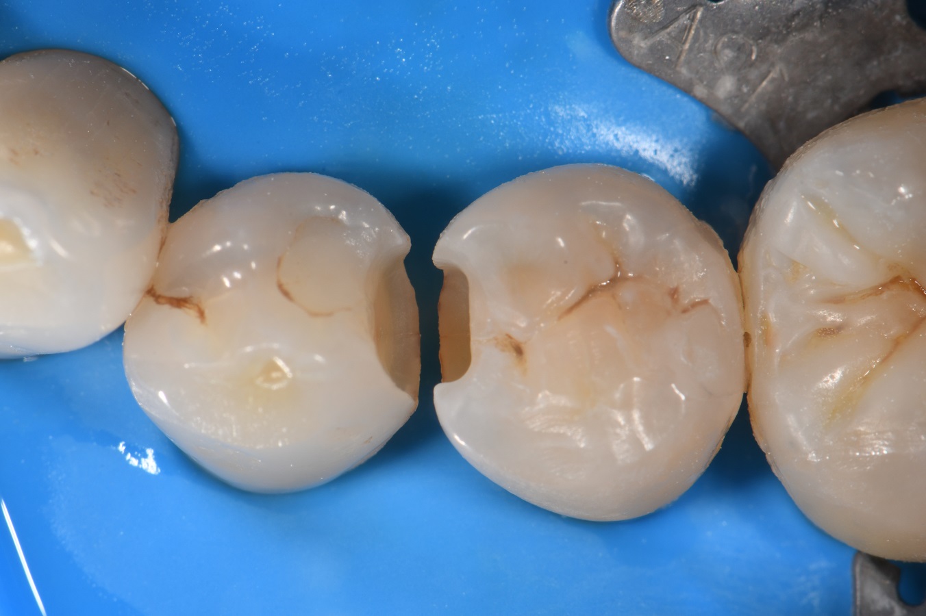 Matrix in Matrix | Back to back Class II Matrix in Matrix | Back to ...