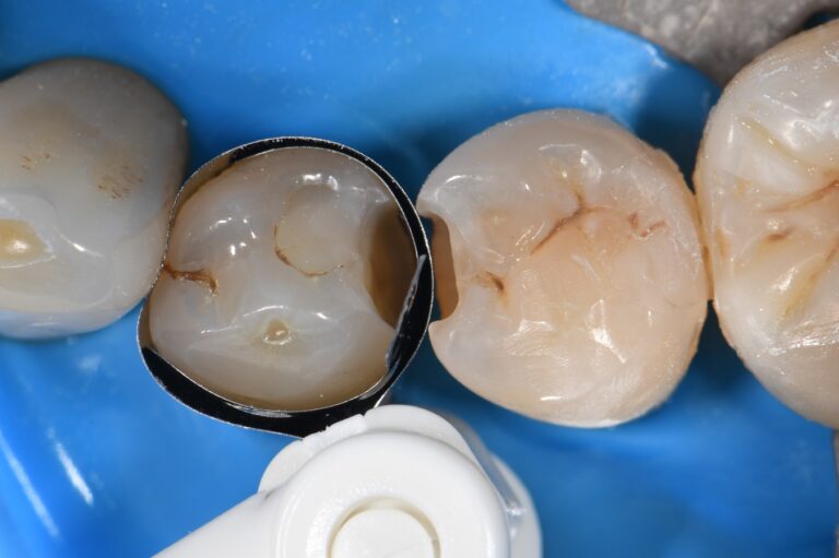 Matrix in Matrix | Back to back Class II Matrix in Matrix | Back to ...