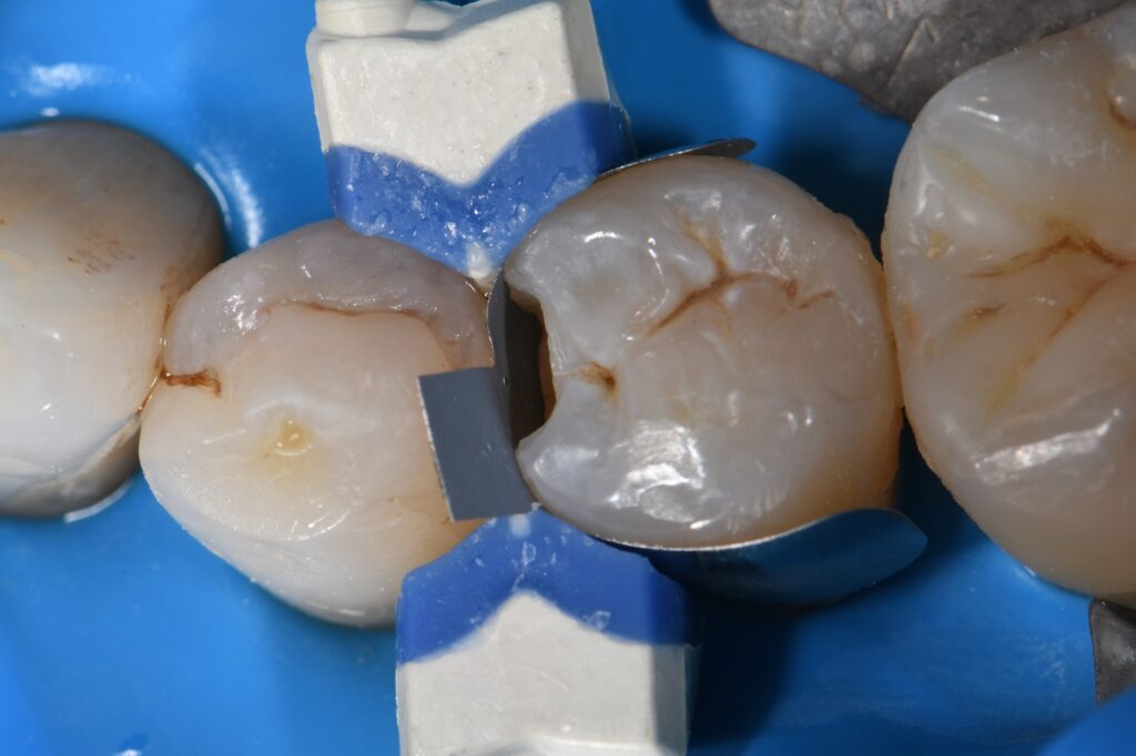 Matrix in Matrix | Back to back Class II Matrix in Matrix | Back to ...