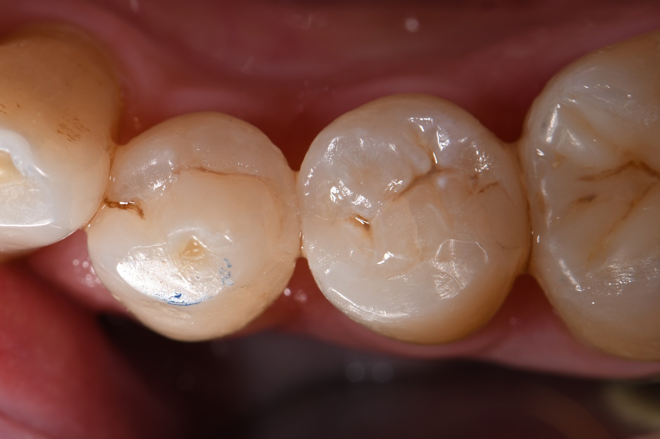 Matrix in Matrix | Back to back Class II Matrix in Matrix | Back to ...