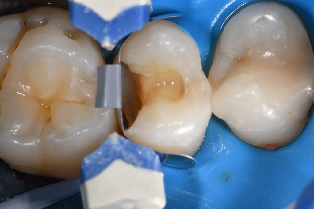 Composite Replacement due to Recurrent Caries