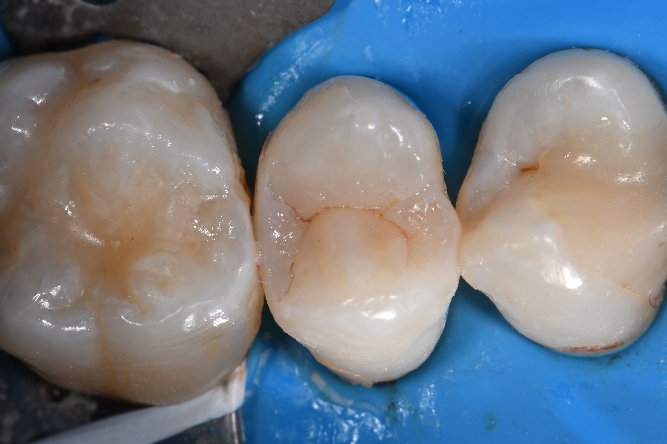 Composite Replacement due to Recurrent Caries