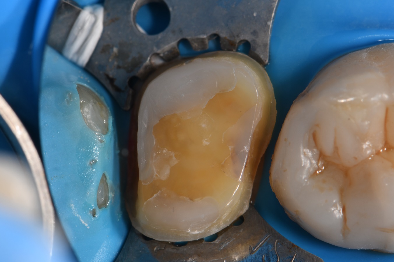 Flexural modulus recovery using bonded indirect ceramics