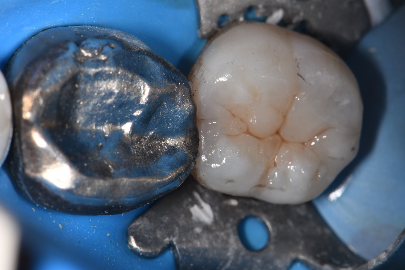 Reconstructing a Broken Down Molar