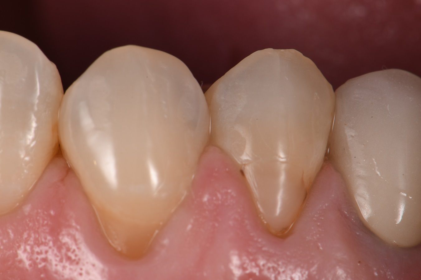 Covering Roots, Enhancing Smiles