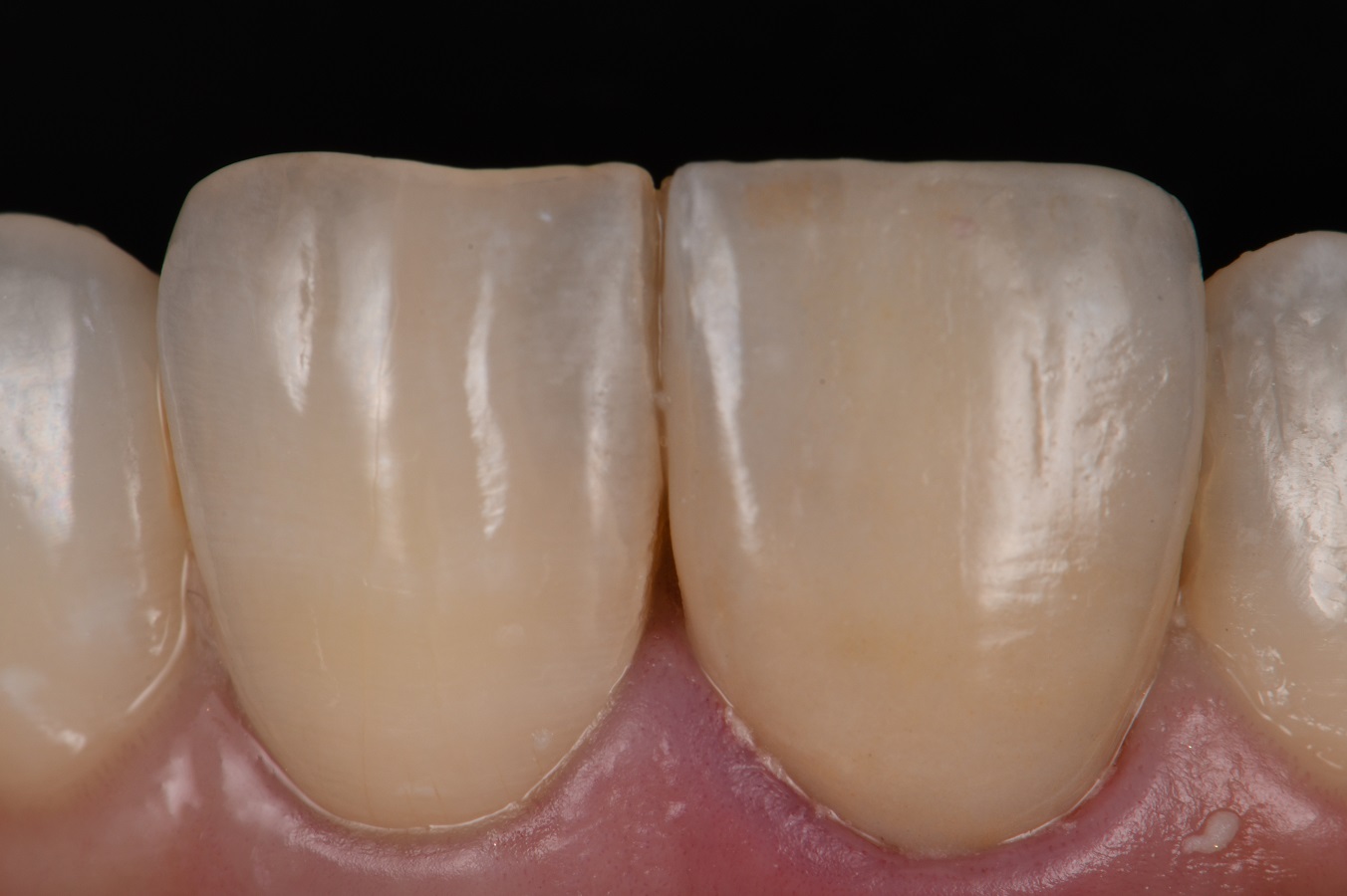 Panavia Veneer LC Cementation of a single veneer