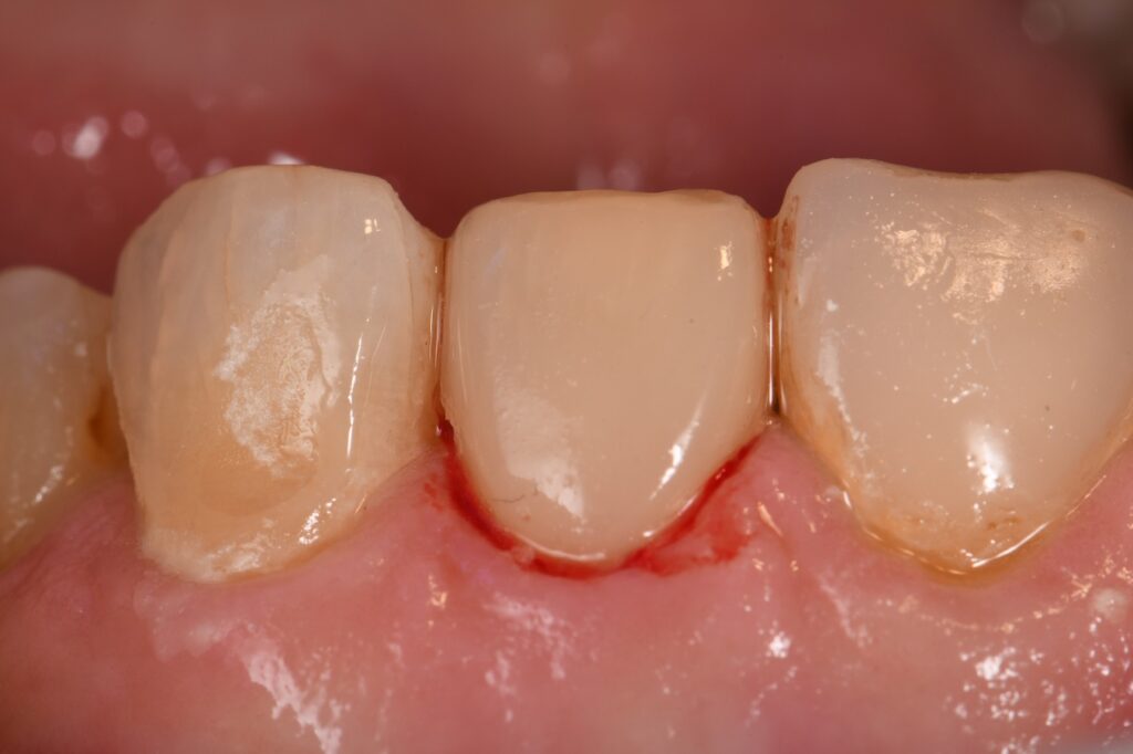 Refacing a tooth using composite resin