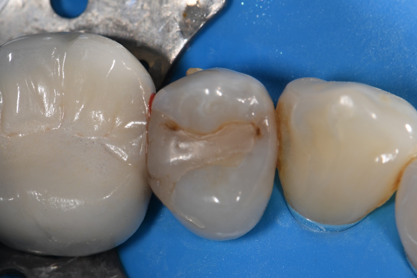 Bicuspid Reconstruction using Garrison Dental Solution Wide Prep Ring