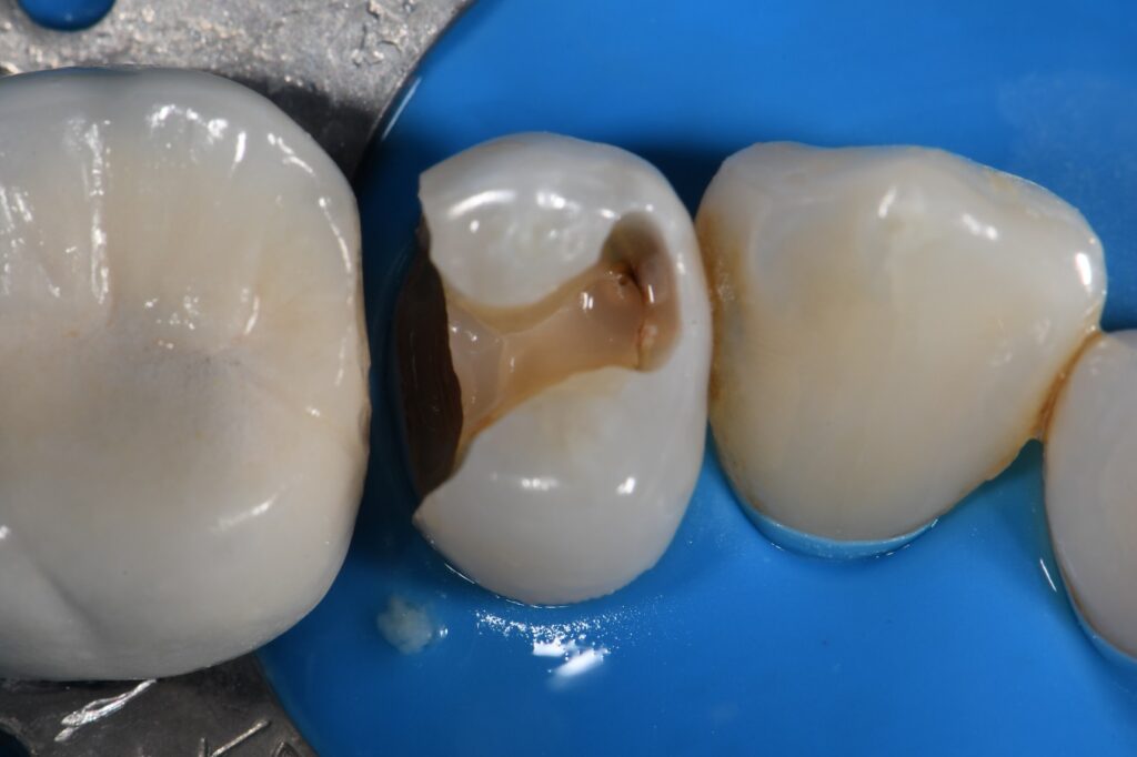 Bicuspid Reconstruction using Garrison Dental Solution Wide Prep Ring