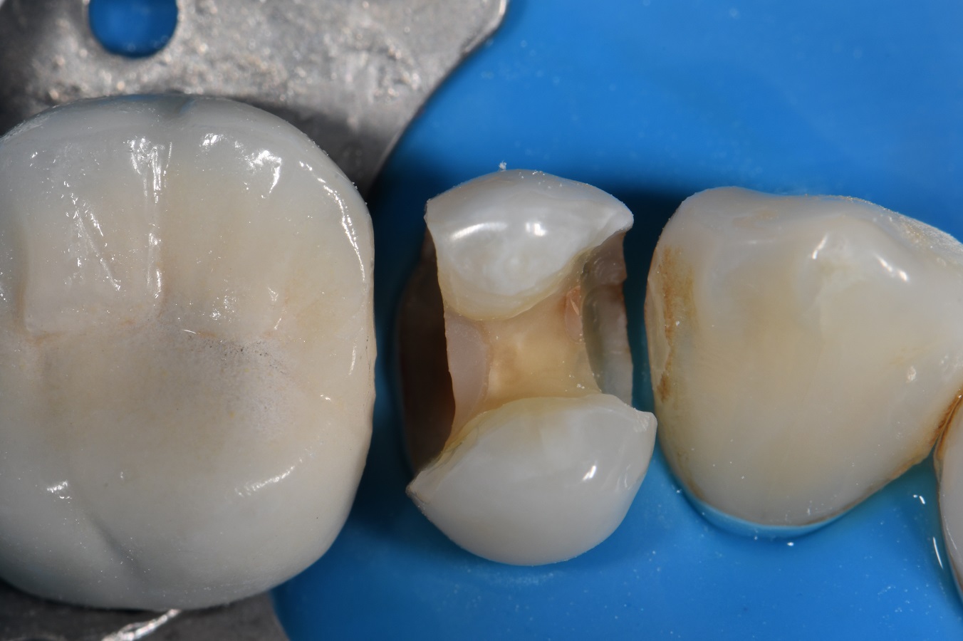 Bicuspid Reconstruction using Garrison Dental Solution Wide Prep Ring