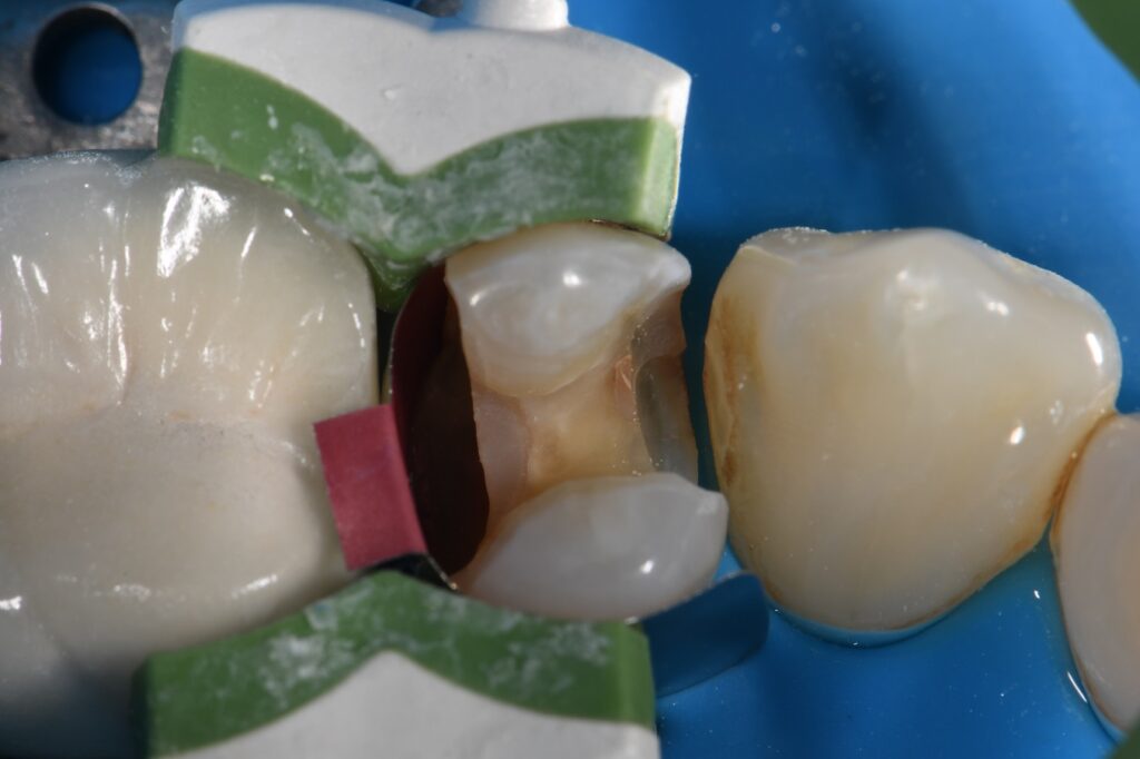 Bicuspid Reconstruction using Garrison Dental Solution Wide Prep Ring