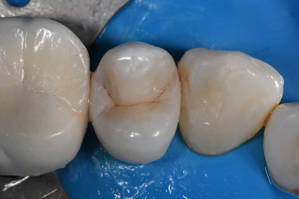 Bicuspid Reconstruction using Garrison Dental Solution Wide Prep Ring