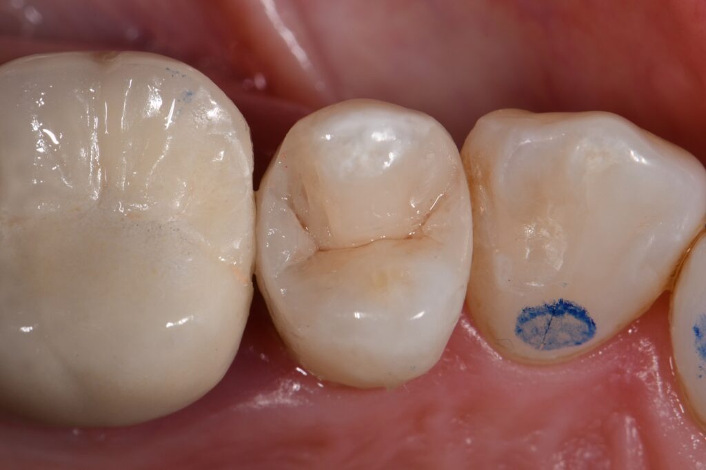 Bicuspid Reconstruction using Garrison Dental Solution Wide Prep Ring