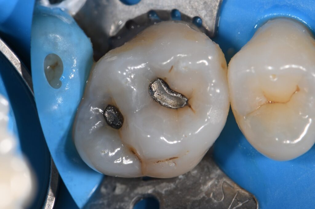 Amalgam Removal Safely with Rubber Dam