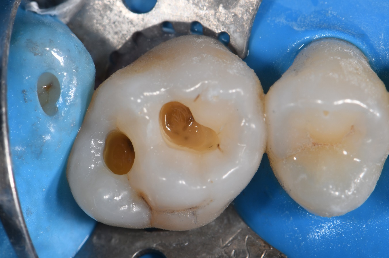 Amalgam Removal Safely with Rubber Dam