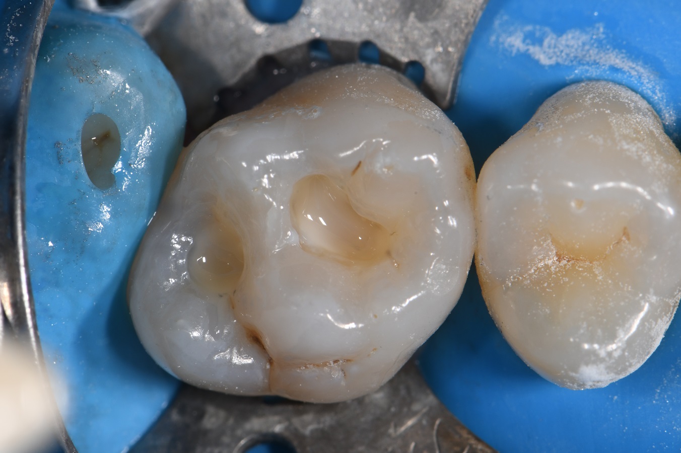 Amalgam Removal Safely with Rubber Dam