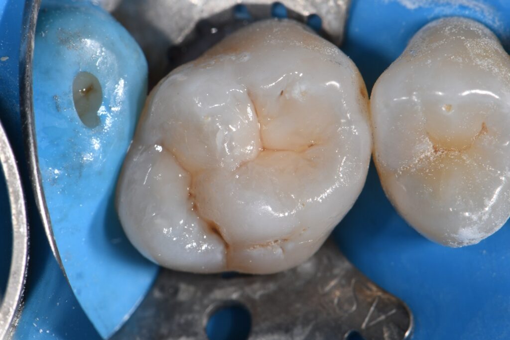 Amalgam Removal Safely with Rubber Dam