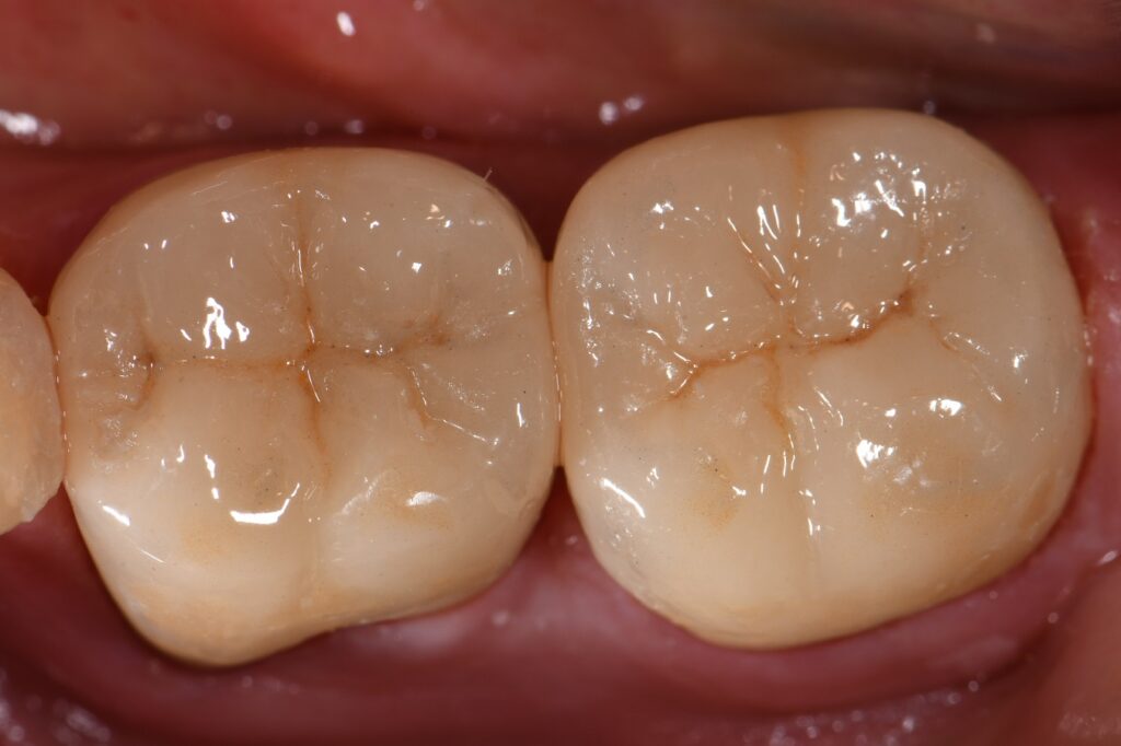 Complex Molar Crown Reconstruction