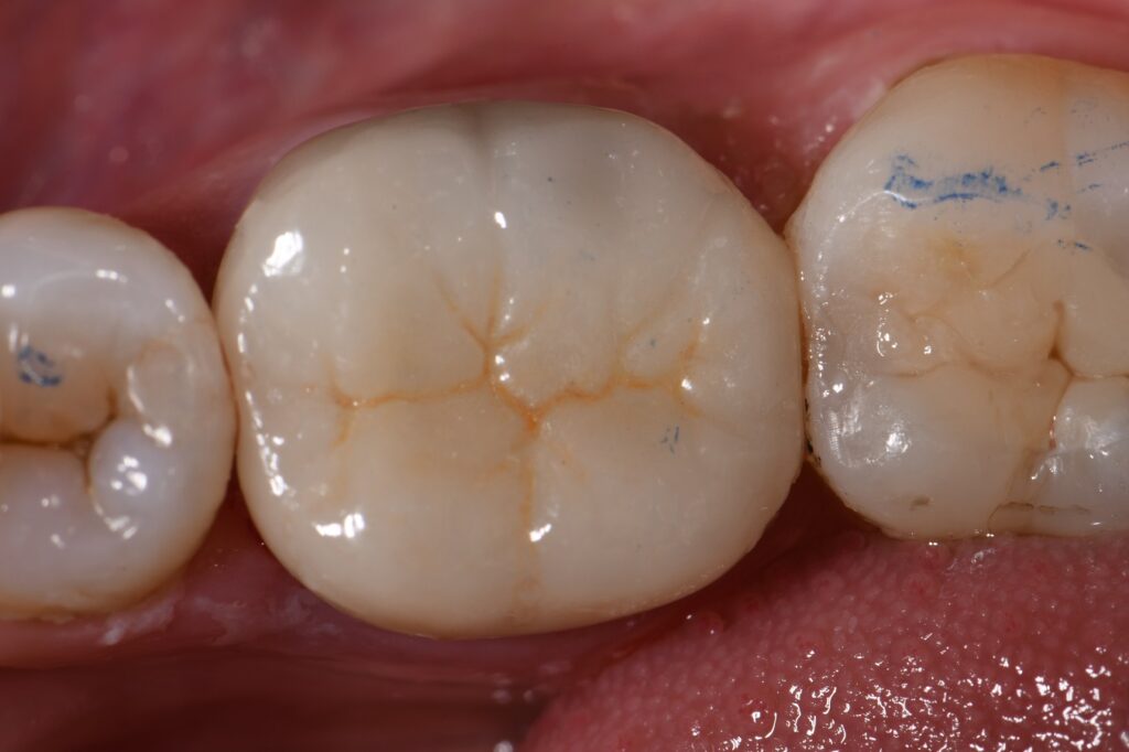 Reconstructing a Broken Down Molar