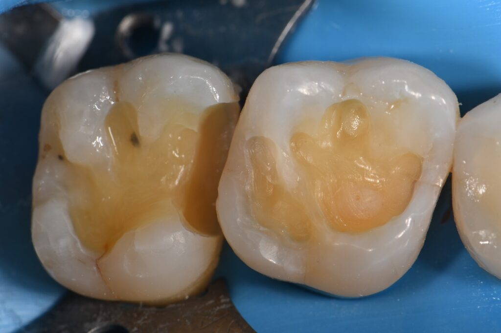 Palodent 360 Matrix in action