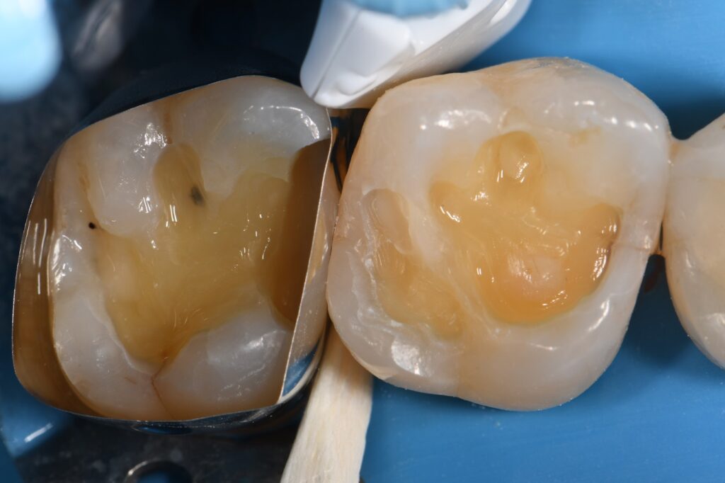 Palodent 360 Matrix in action