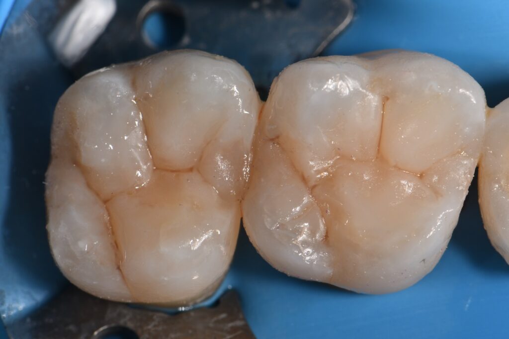 Palodent 360 Matrix in action