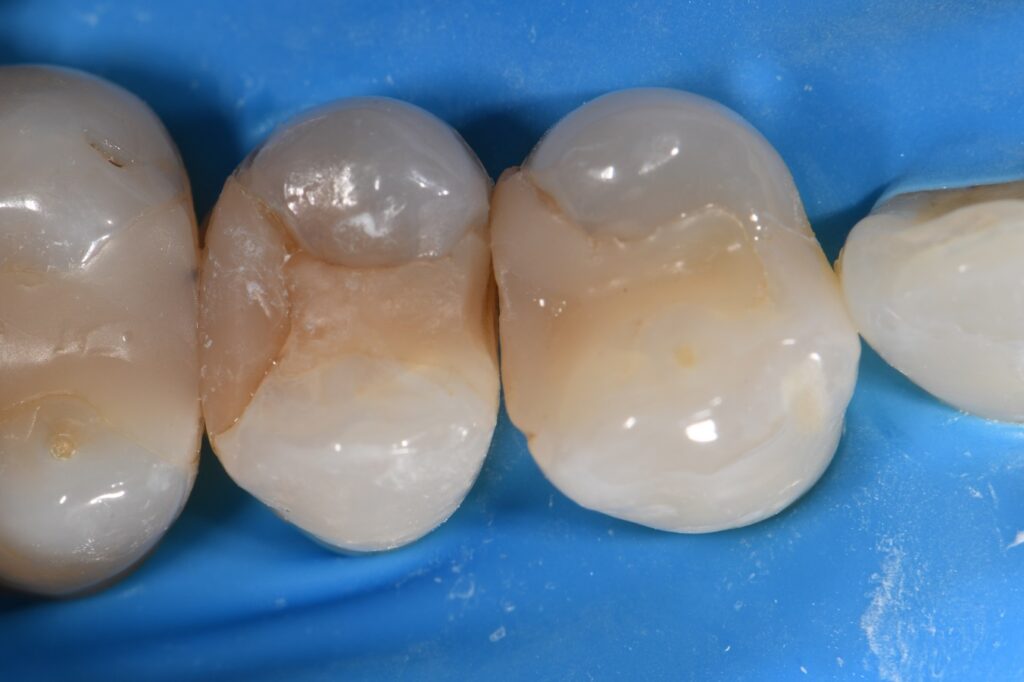Matrix in Matrix Premolar Direct Restoration