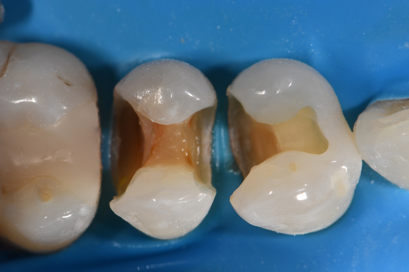 Matrix in Matrix Premolar Direct Restoration
