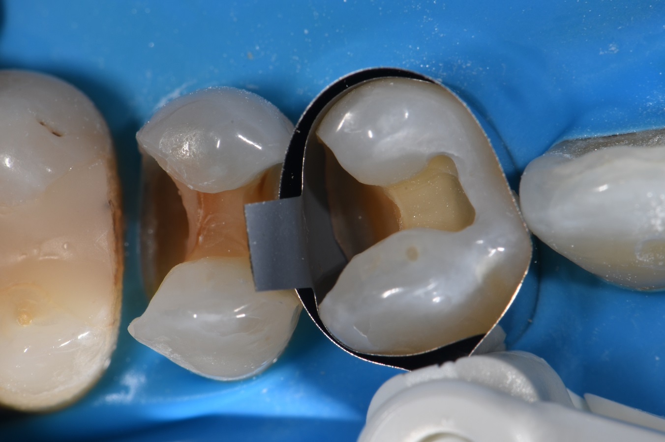 Matrix in Matrix Premolar Direct Restoration