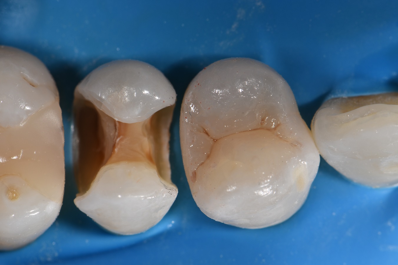 Matrix in Matrix Premolar Direct Restoration