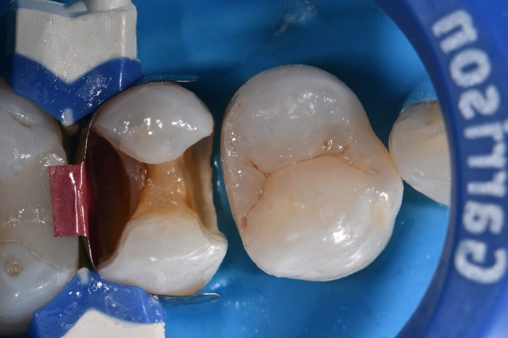 Matrix in Matrix Premolar Direct Restoration