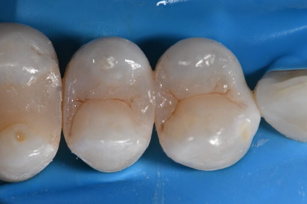 Matrix in Matrix Premolar Direct Restoration