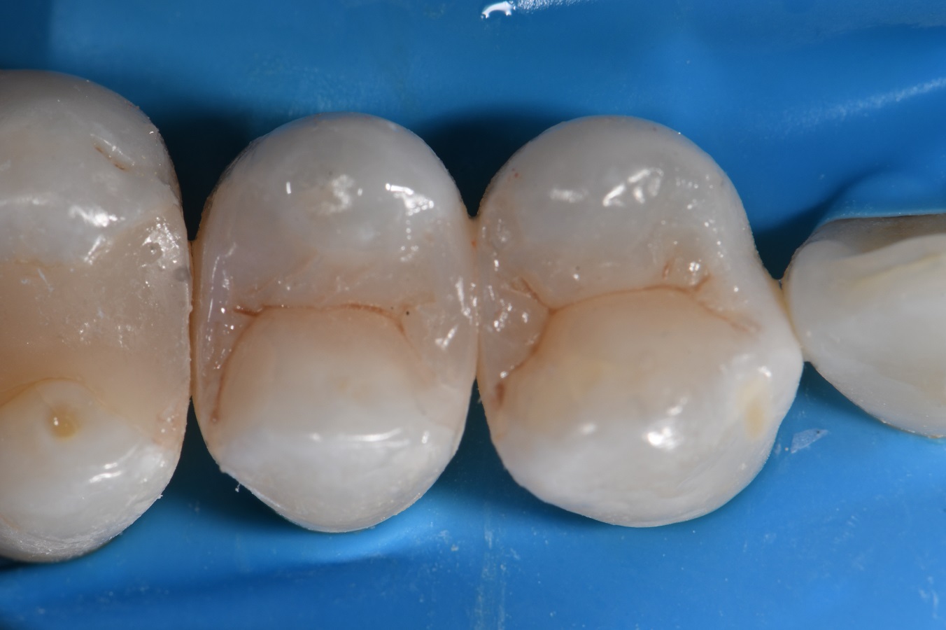 Matrix in Matrix Premolar Direct Restoration