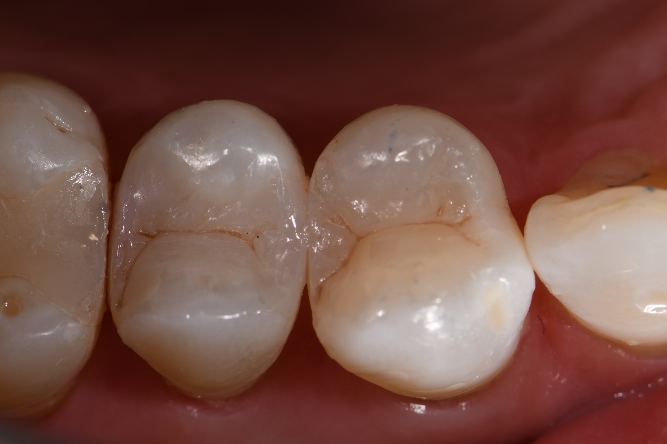 Matrix in Matrix Premolar Direct Restoration
