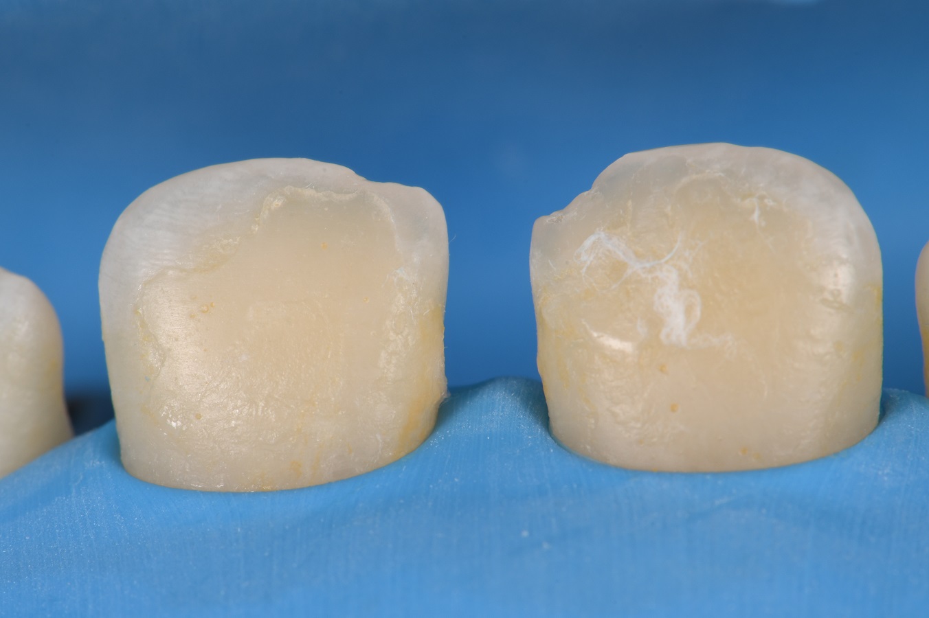 Trampoline dental accidents