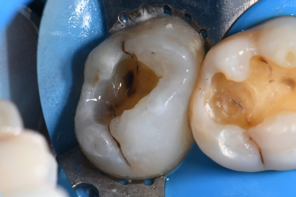 Amalgam Removal on a Distally Tipped Second Molar