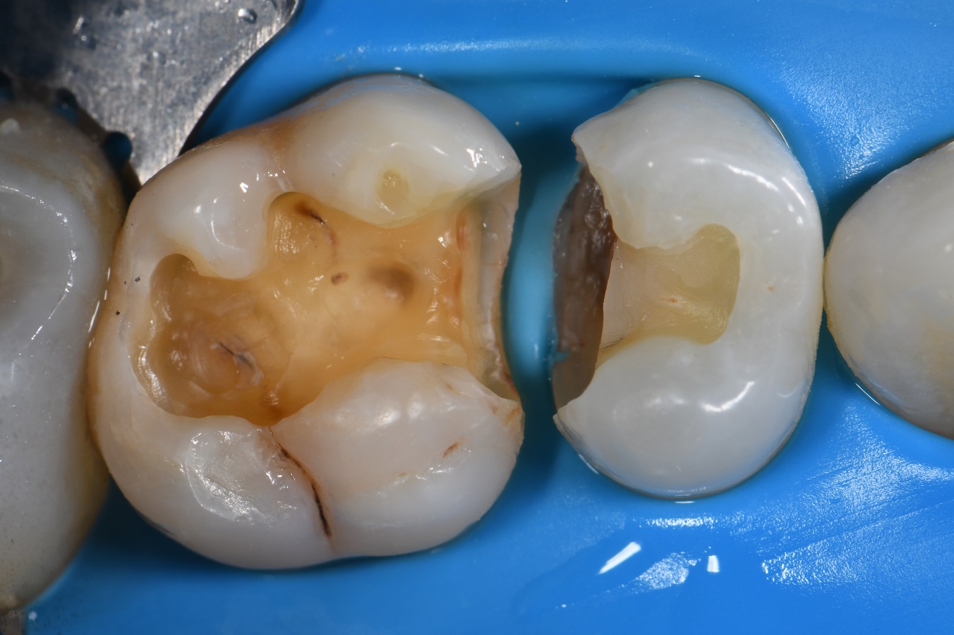 Sequential Matrix use for Class II composites