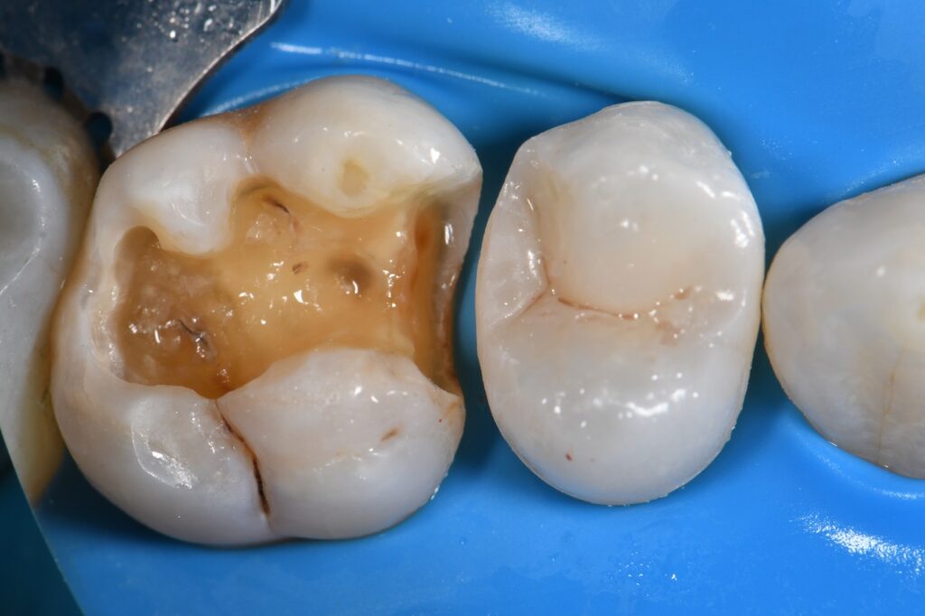 Sequential Matrix use for Class II composites
