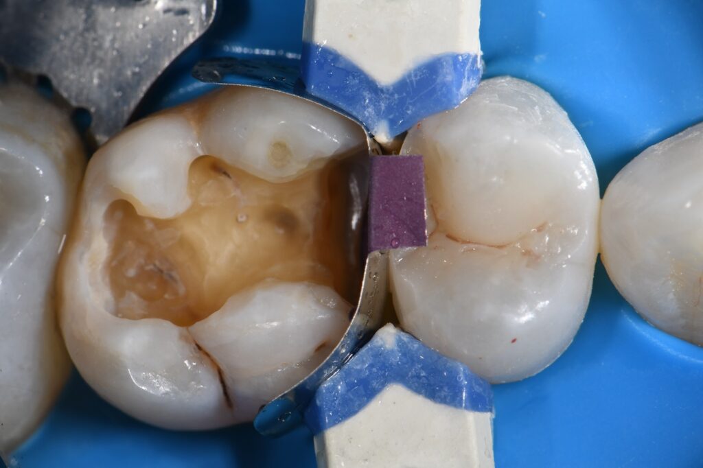 Sequential Matrix use for Class II composites