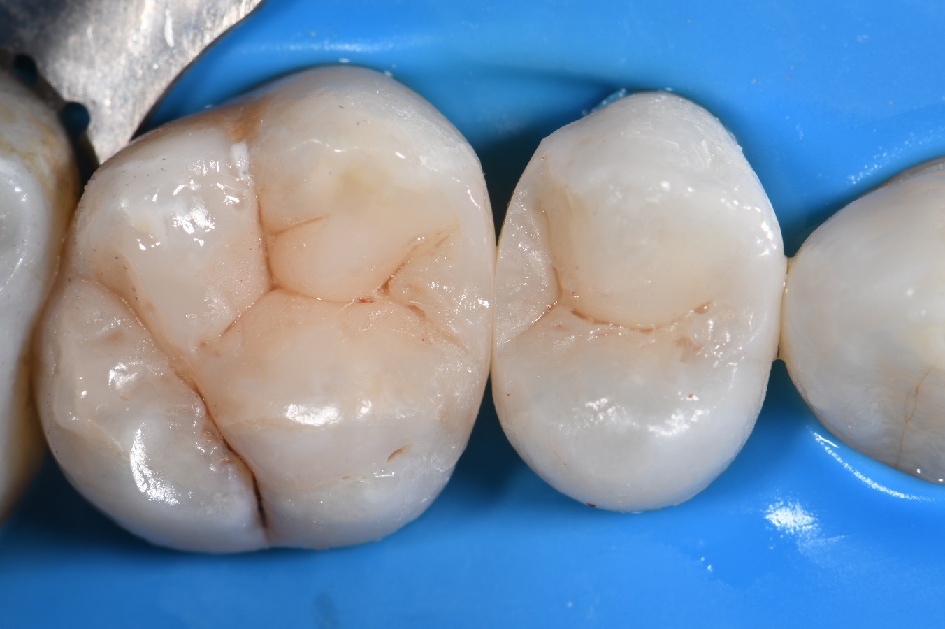 Sequential Matrix use for Class II composites