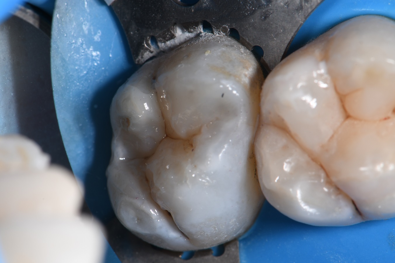 Amalgam Removal on a Distally Tipped Second Molar