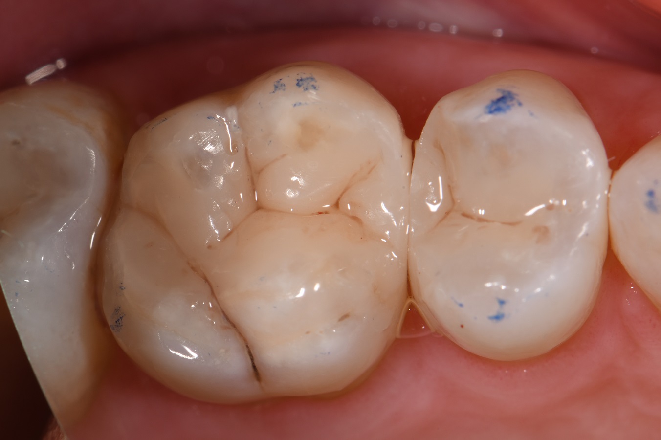 Sequential Matrix use for Class II composites