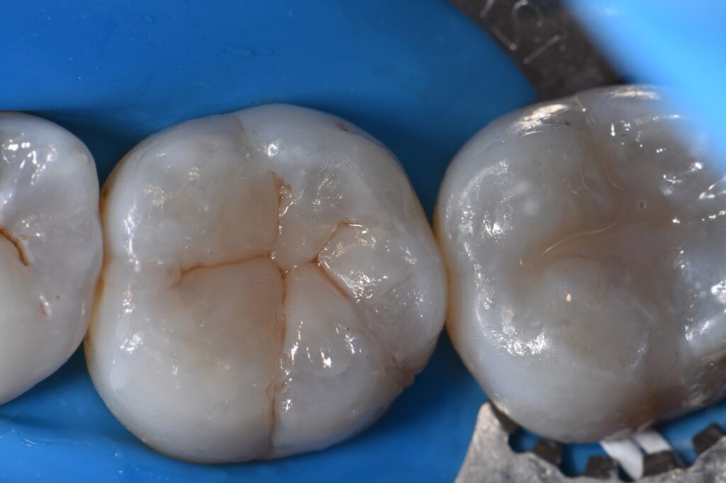 Kerr Simplishade Medium