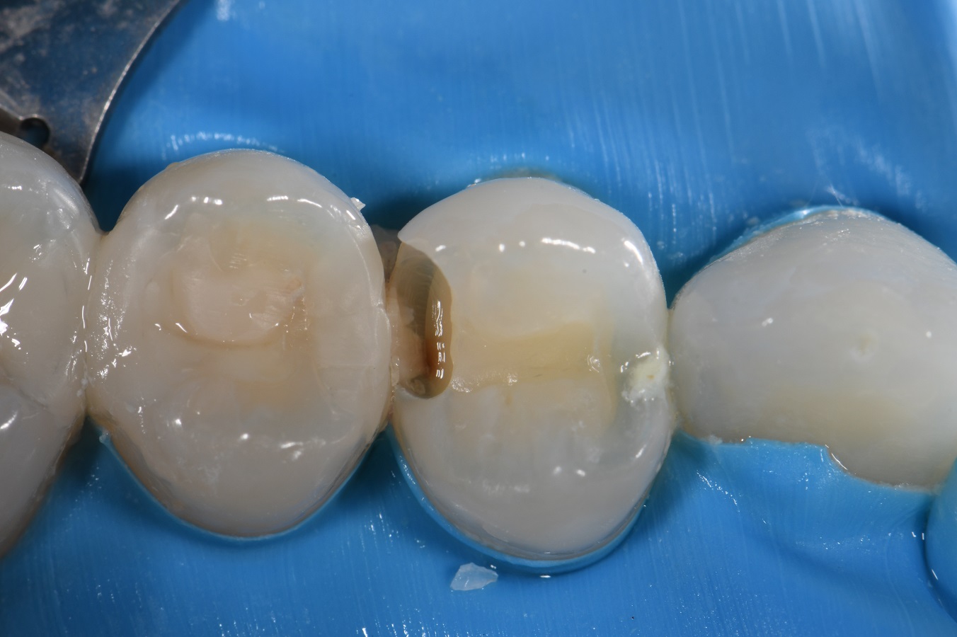 Slot Restoration | Grade D3 caries Slot Restoration | Grade D3 caries