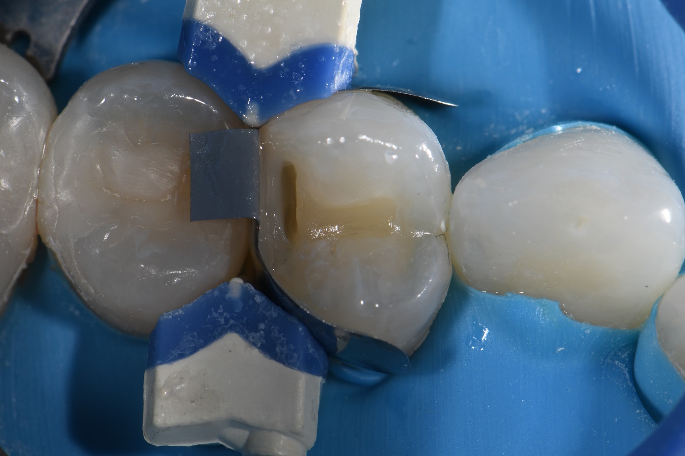 Slot Restoration | Grade D3 caries Slot Restoration | Grade D3 caries