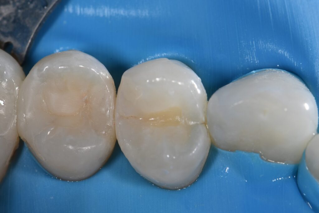 Slot Restoration | Grade D3 caries Slot Restoration | Grade D3 caries