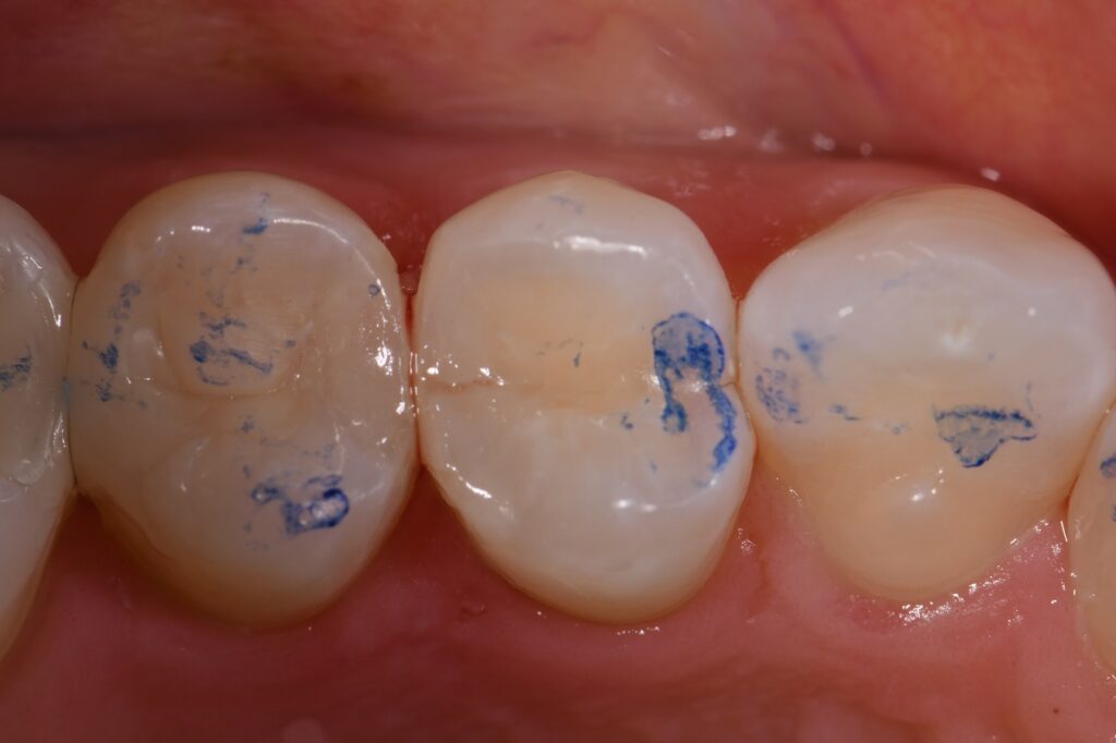 Slot Restoration | Grade D3 caries Slot Restoration | Grade D3 caries